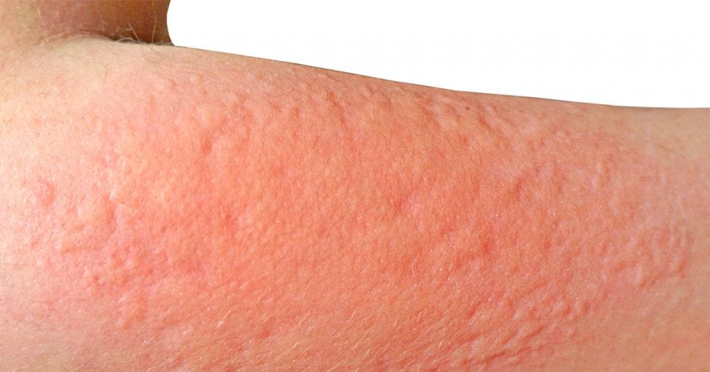 Dermatita Herpetiformă Duhring-Brocq| Dr. Leventer Centre