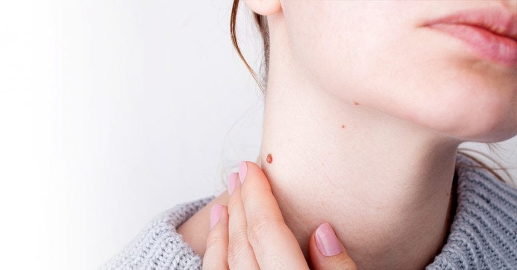 Papiloamele - ce sunt și cum le putem trata cu succes