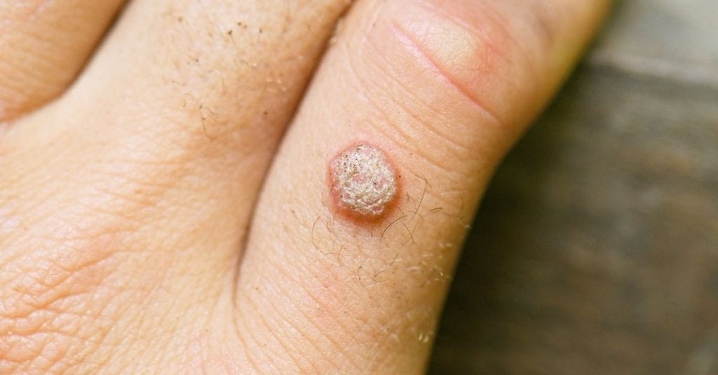 Veruci. Cauzele Apariției, Tipuri și Tratament | Dr. Leventer Centre