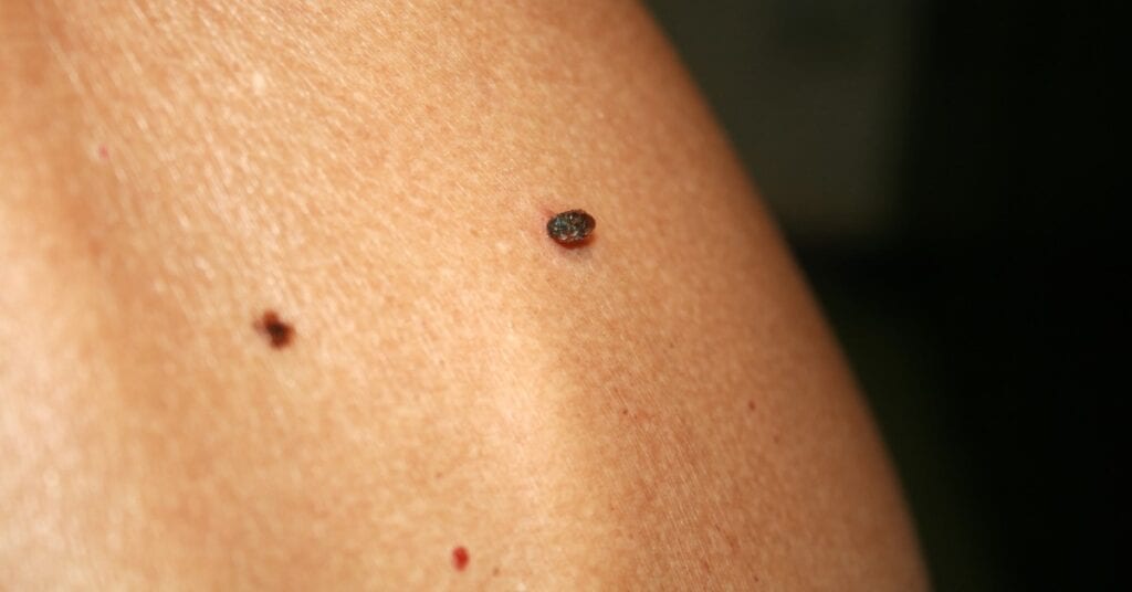 Papiloame cutanate - cauze și tratament - Dr. Leventer Centre