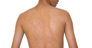 Pitiriazis rozat Gibert. Cum se manifestă boala și cum o tratăm? - Dr ...