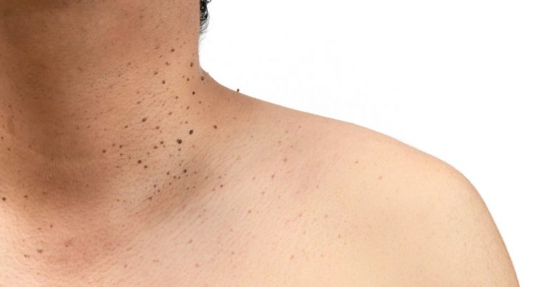 Excrescențe pe piele care necesită atenția medicului dermatolog - Dr ...