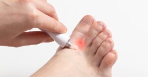 Intertrigo, afecțiune inflamatorie a pielii - Dr. Leventer Centre