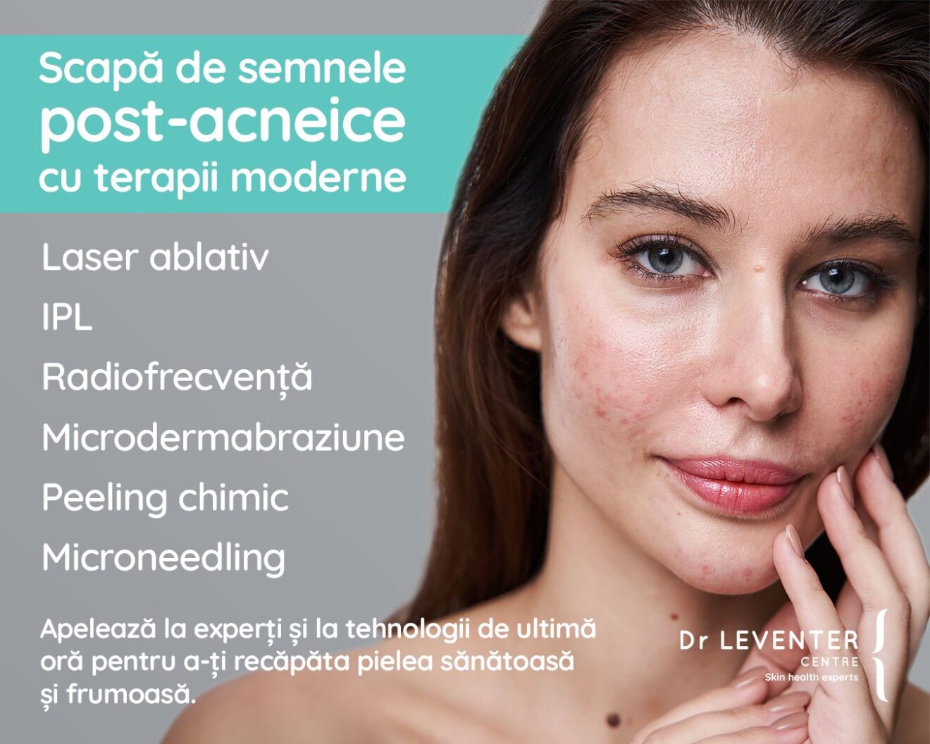 Tratamentul semnelor post-acneice. Scapă de cicatrici cu ajutorul ...