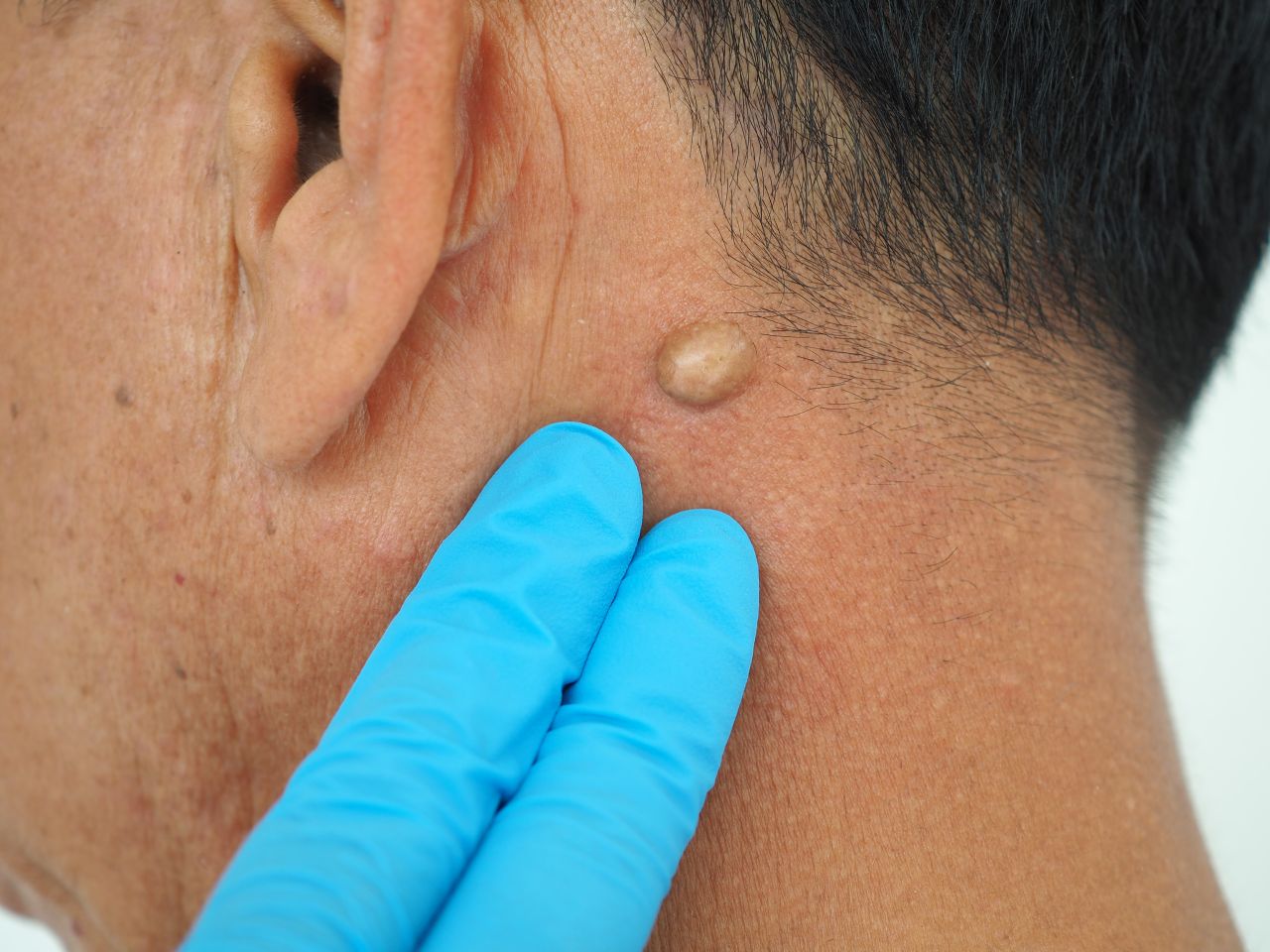 Chistul sebaceu infectat. Când apare? Simptome și tratament - Dr ...