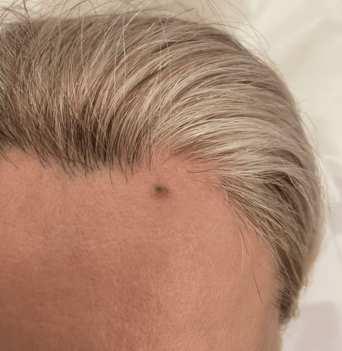 Poze cu cancer de piele. Imaginile care te vor ajuta să recunoști ...